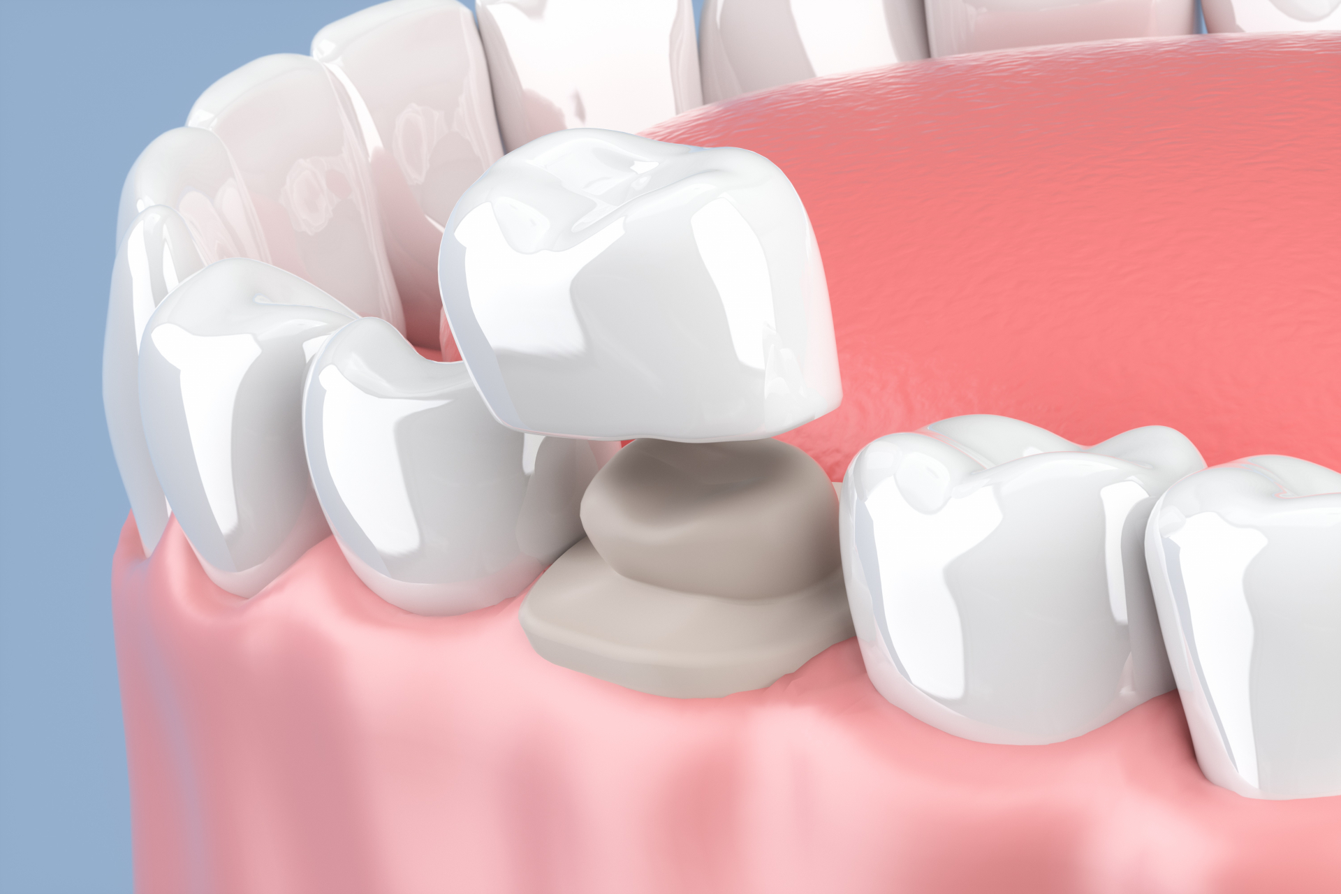 e-max（イーマックス）とは？メリット・デメリットも解説 ｜ WITH DENTAL CLINIC｜代官山・新宿・銀座の矯正歯科・審美歯科